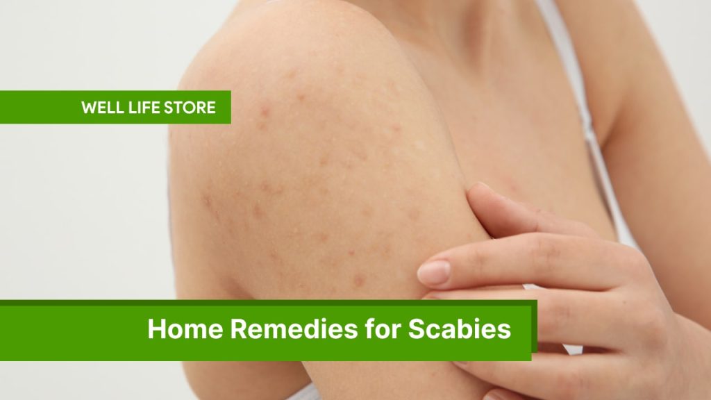 5 Home Remedies for Scabies - Well Life Store